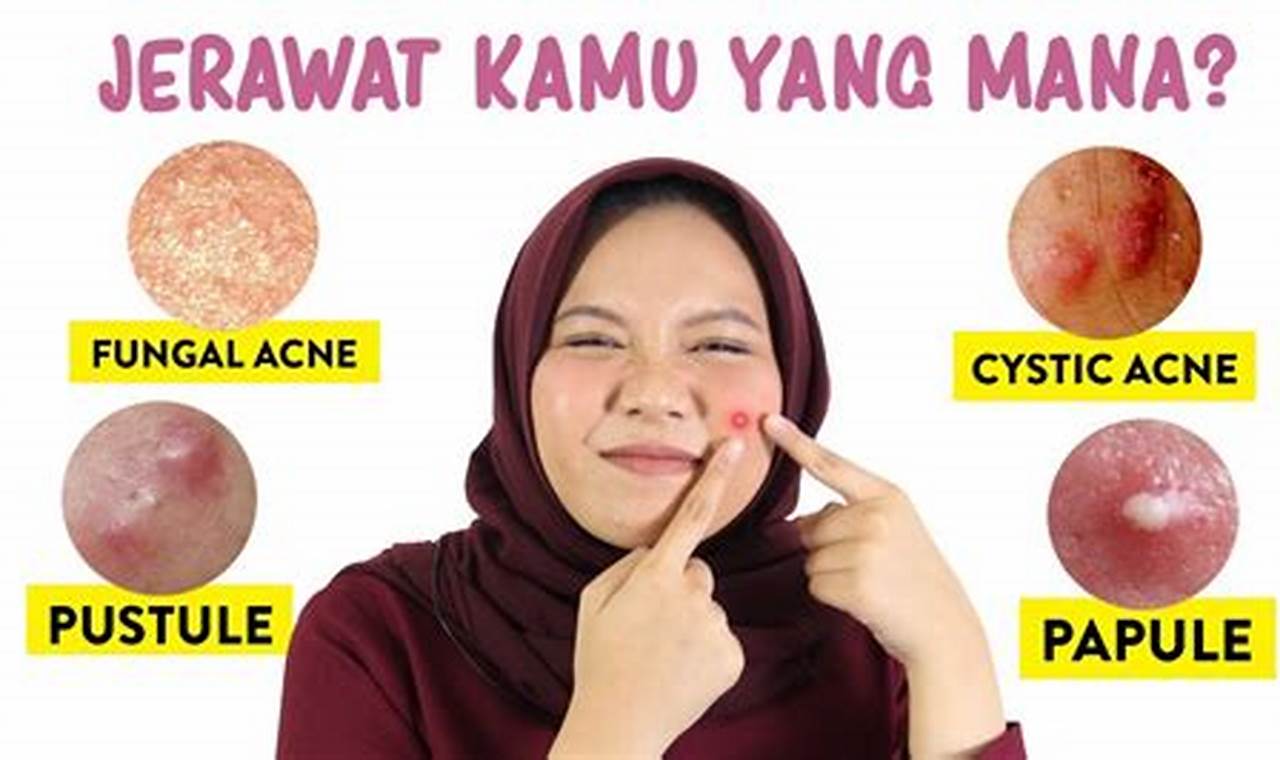 Cara Mengatasi Jerawat: Panduan Lengkap Untuk Kulit Bersih Bebas ...