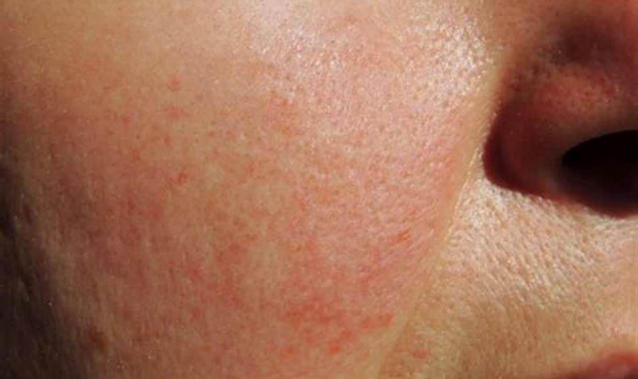 Cara Mengatasi Muka Merah Dengan Mudah Dan Efektif | investigasi.id